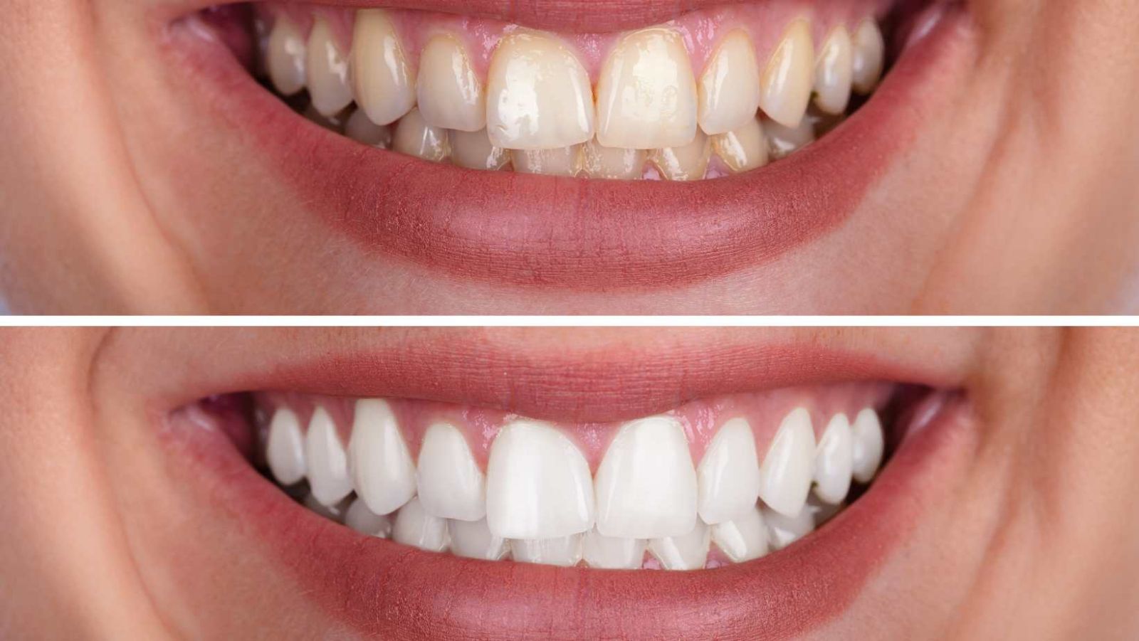 Les 8 meilleures astuces naturelles pour dire adieu au tartre dentaire