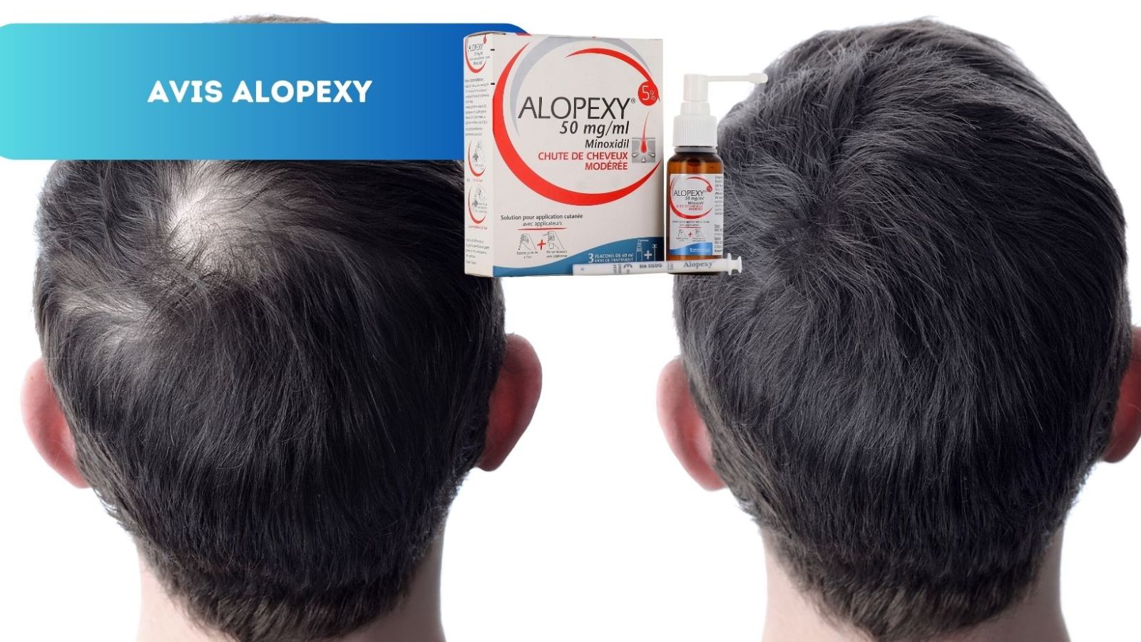 Alopexy Avis : Une Solution Contre l'Alopécie Androgénétique
